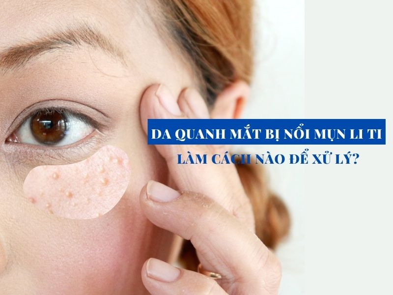 Da Quanh Mắt Bị Nổi Mụn Li Ti Làm Cách Nào Để Xử Lý?
